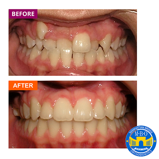 Before and After Cases Treated at Manhattan Bridge Orthodontics ...